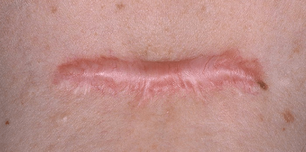 Xstrahl in action: Optimizing Radiotherapy for Keloids - Xstrahl