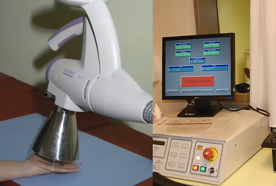 Radiotherapy of Inflammatory Disorders on Palms and Soles, Dr. Reinhard ...