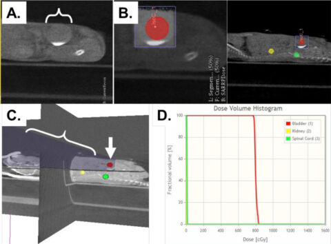 Prevention of Radiation-Induced Bladder Injury - Xstrahl