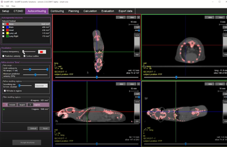 SmART-XPS Auto-Contouring - Xstrahl